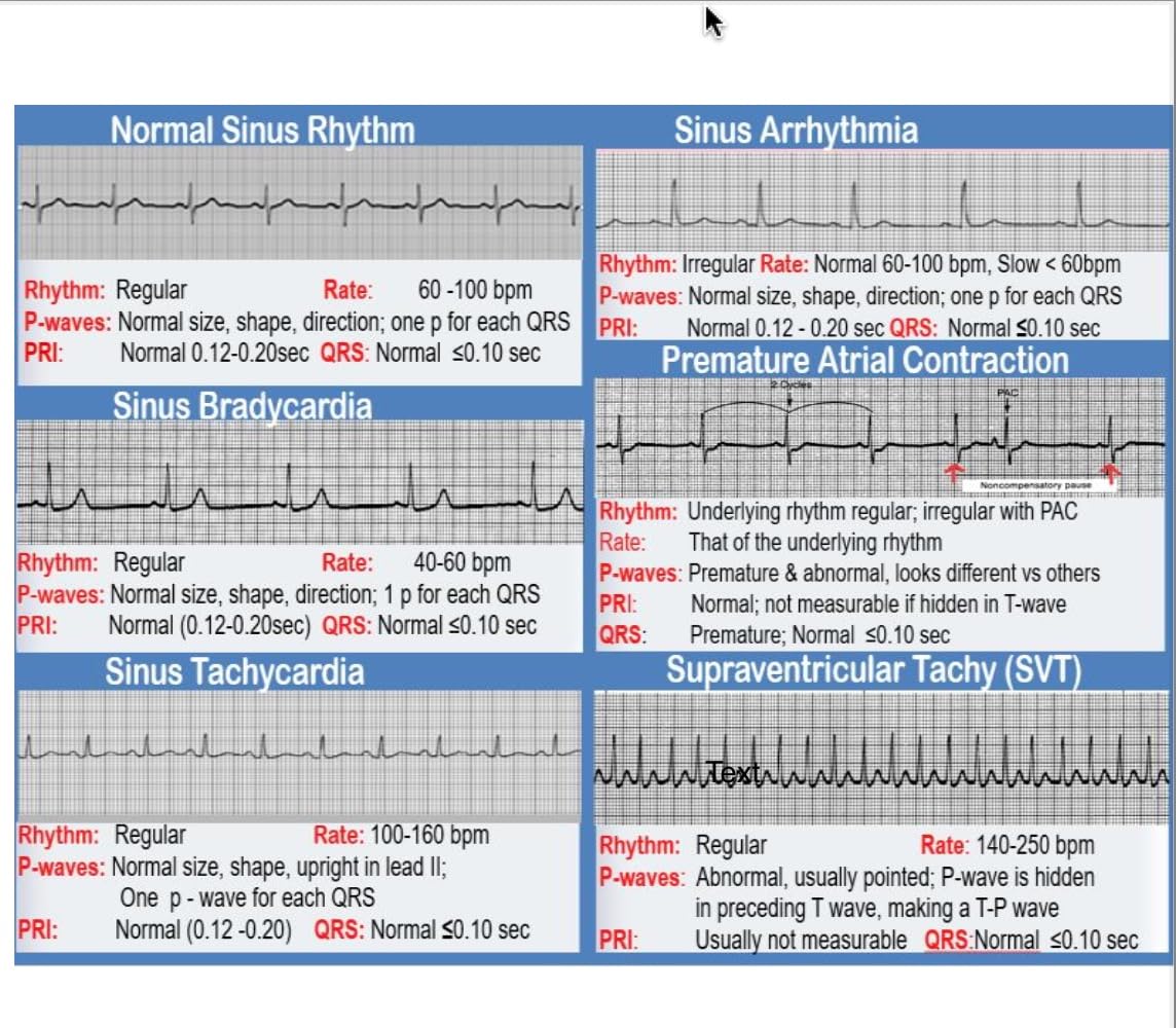 Buy EKG ECG Quick Rythm Analysis Hero Badge Cards Reference Guide with ...