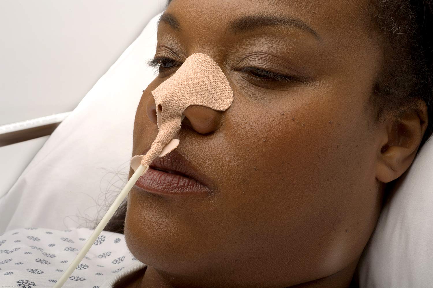 Nasogastric Tube Suction, Nasogastric Tube Feeding, 58% OFF