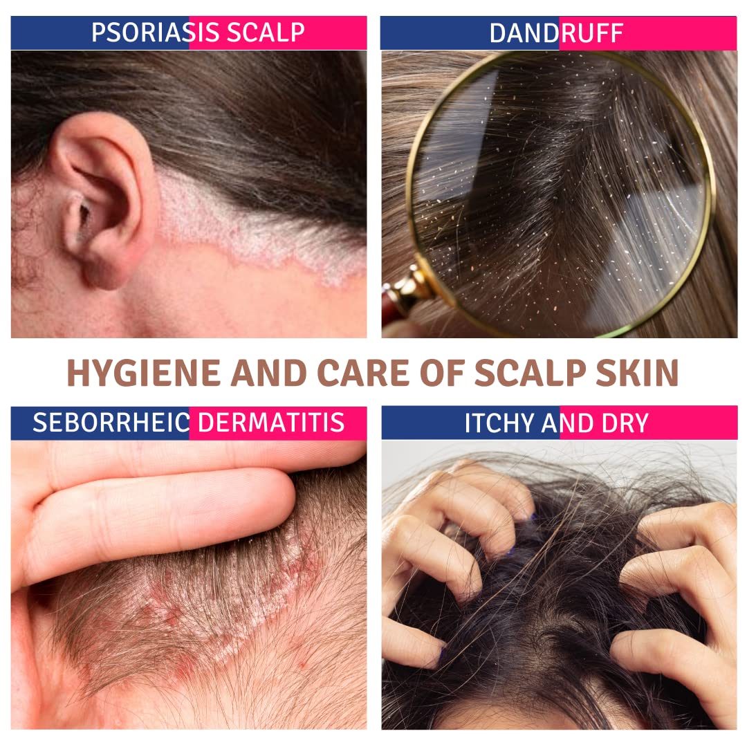 PsoriTIS, 10% Urea Shampoo - Perfect for Seborrheic and Psoriasis Scalp ...