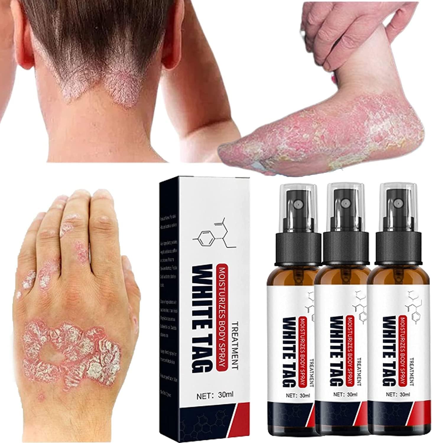 30ml Kolmax Psoriasis Relief Spray, Dermax Psoriasis Treatment Spray ...