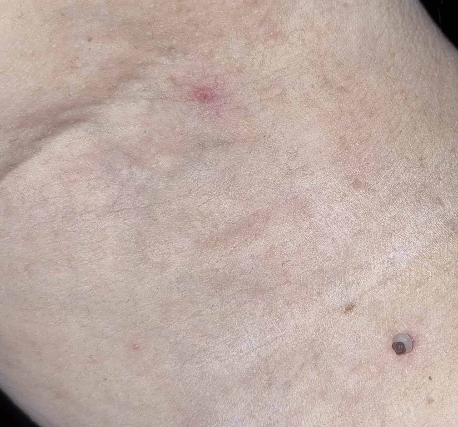 Auto Skin Tag Removal Pen - Skin Tag Remover 2 in 1 Standard and Micro ...