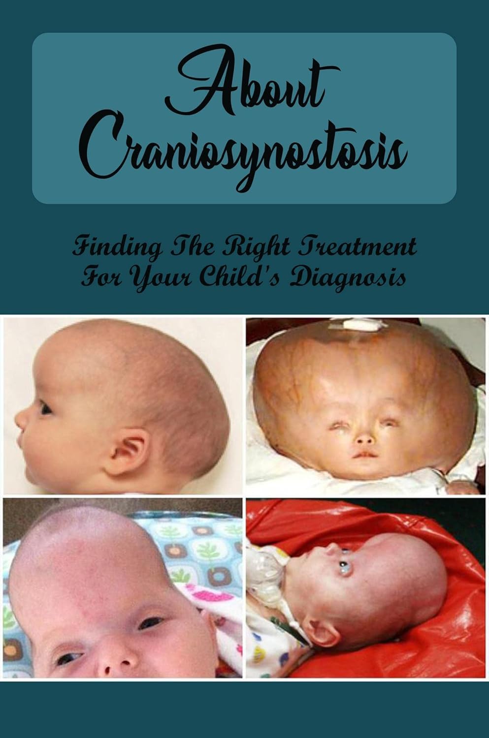 About Craniosynostosis: Finding The Right Treatment For Your Child's ...