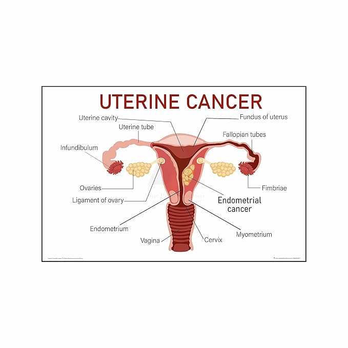 Anne Print Solutions® Uterine Cancer chart Poster For Hospital Posters | Nursing Home Posters ...