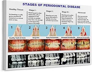 Amazon.com: Stages of Periodontal Disease Dental Clinic Guide Poster ...