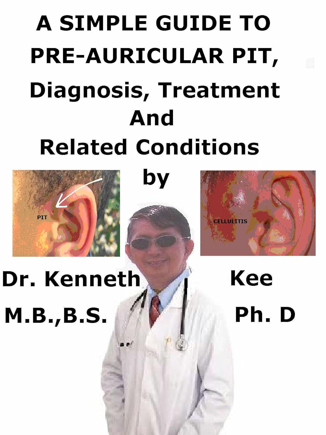 A Simple Guide To Pre-auricular Pit, Diagnosis, Treatment And Related ...