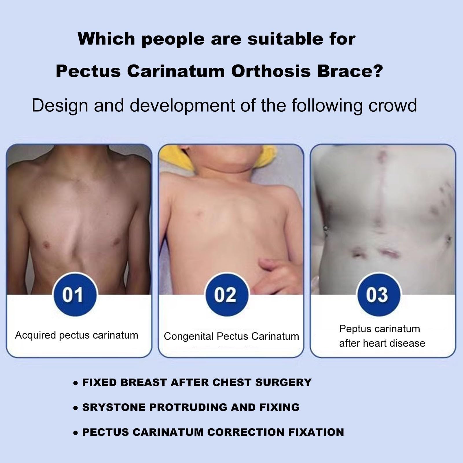 Pectus Carinatum Minimally Invasive Repair Of Symmetric Pectus