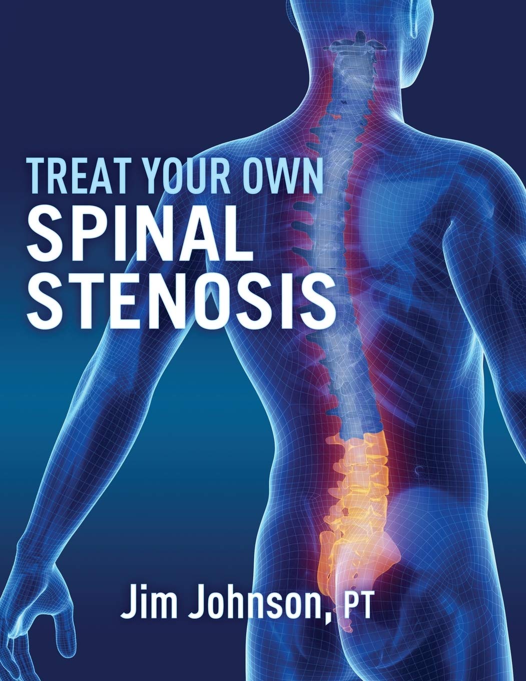 Treat Your Own Spinal Stenosis: Johnson, Jim: 9781642379587: Amazon.com ...
