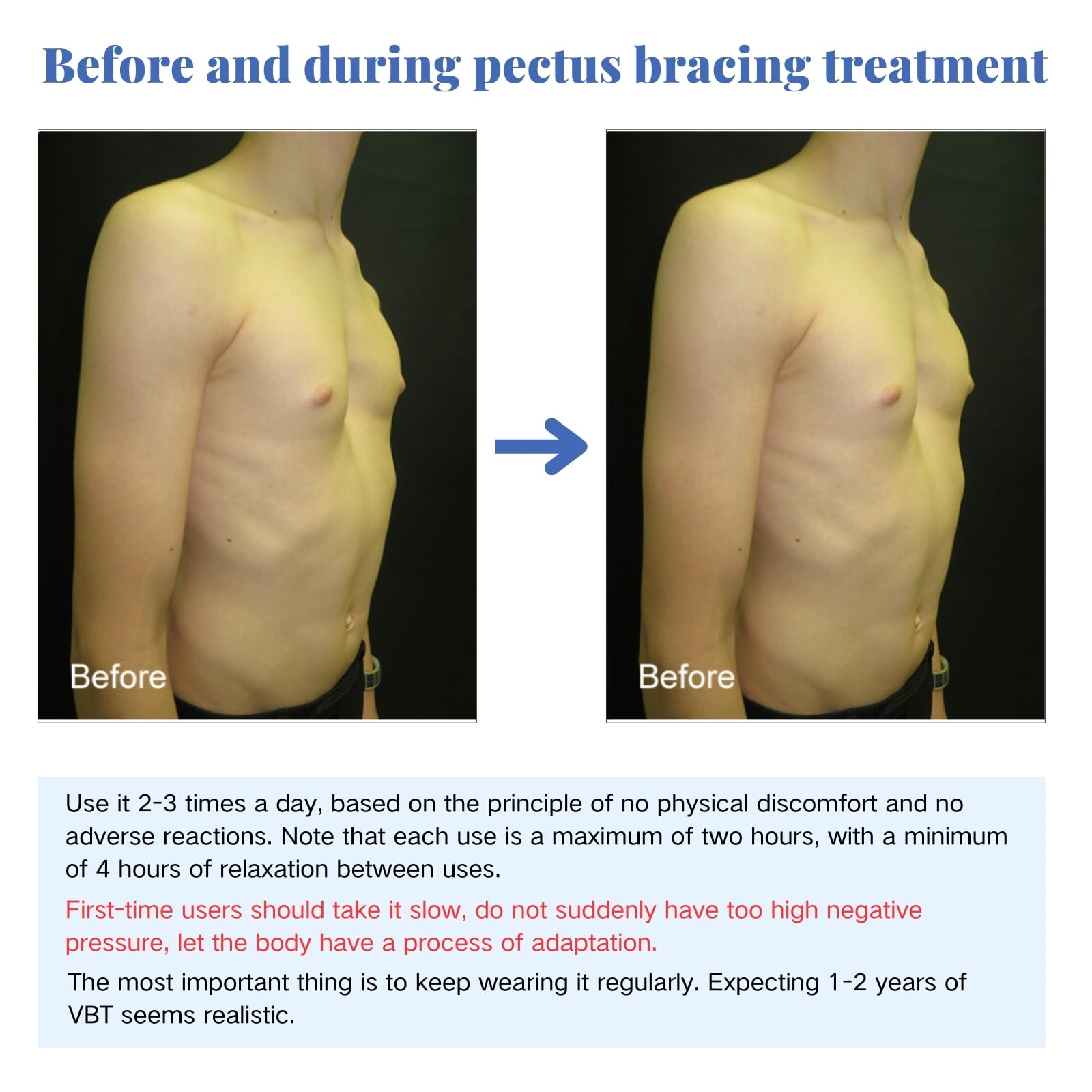 Pectus Excavatum Brace Australia