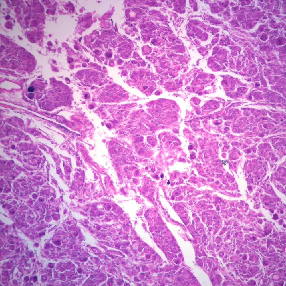 Emphysema Lung Slide