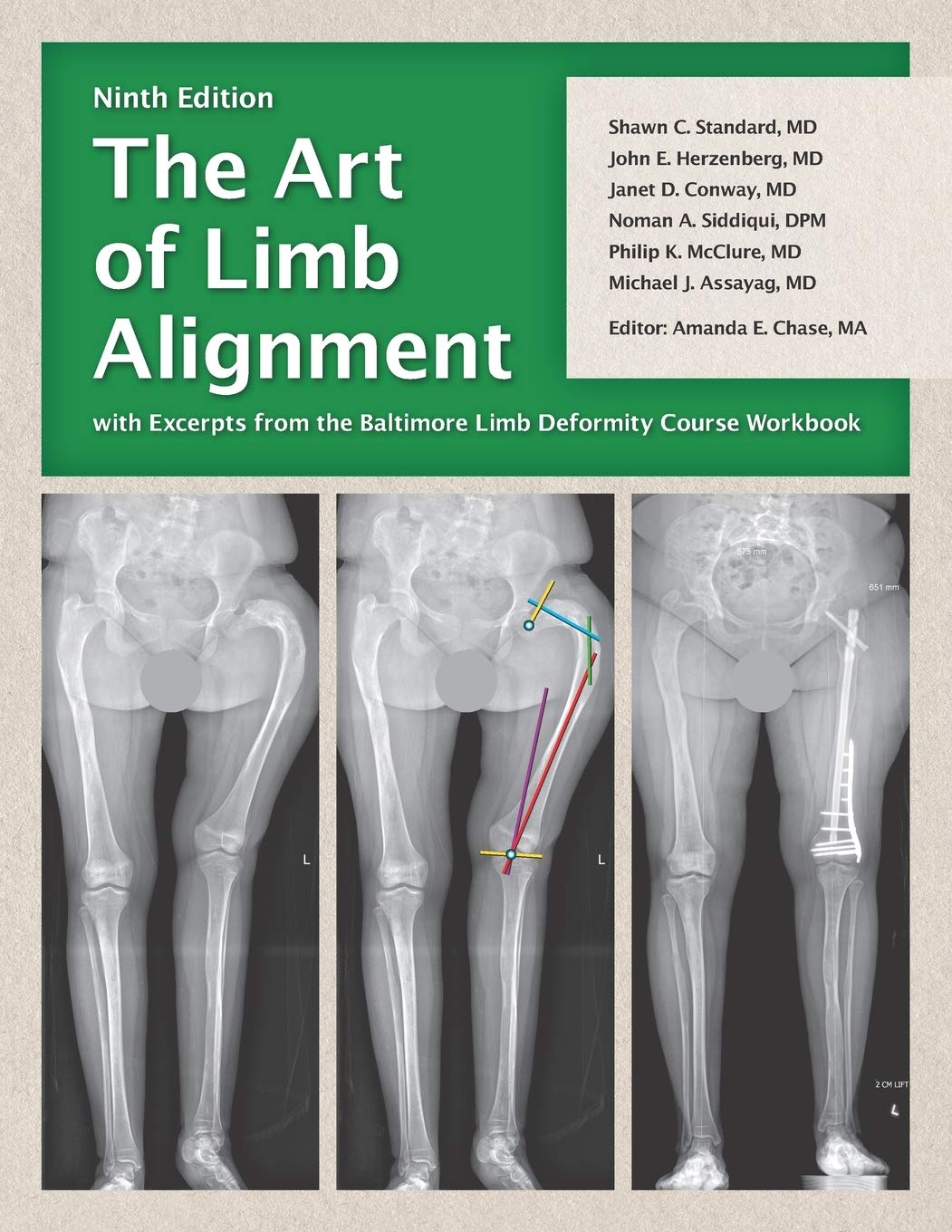 The Art of Limb Alignment with Excerpts from the Baltimore Limb ...