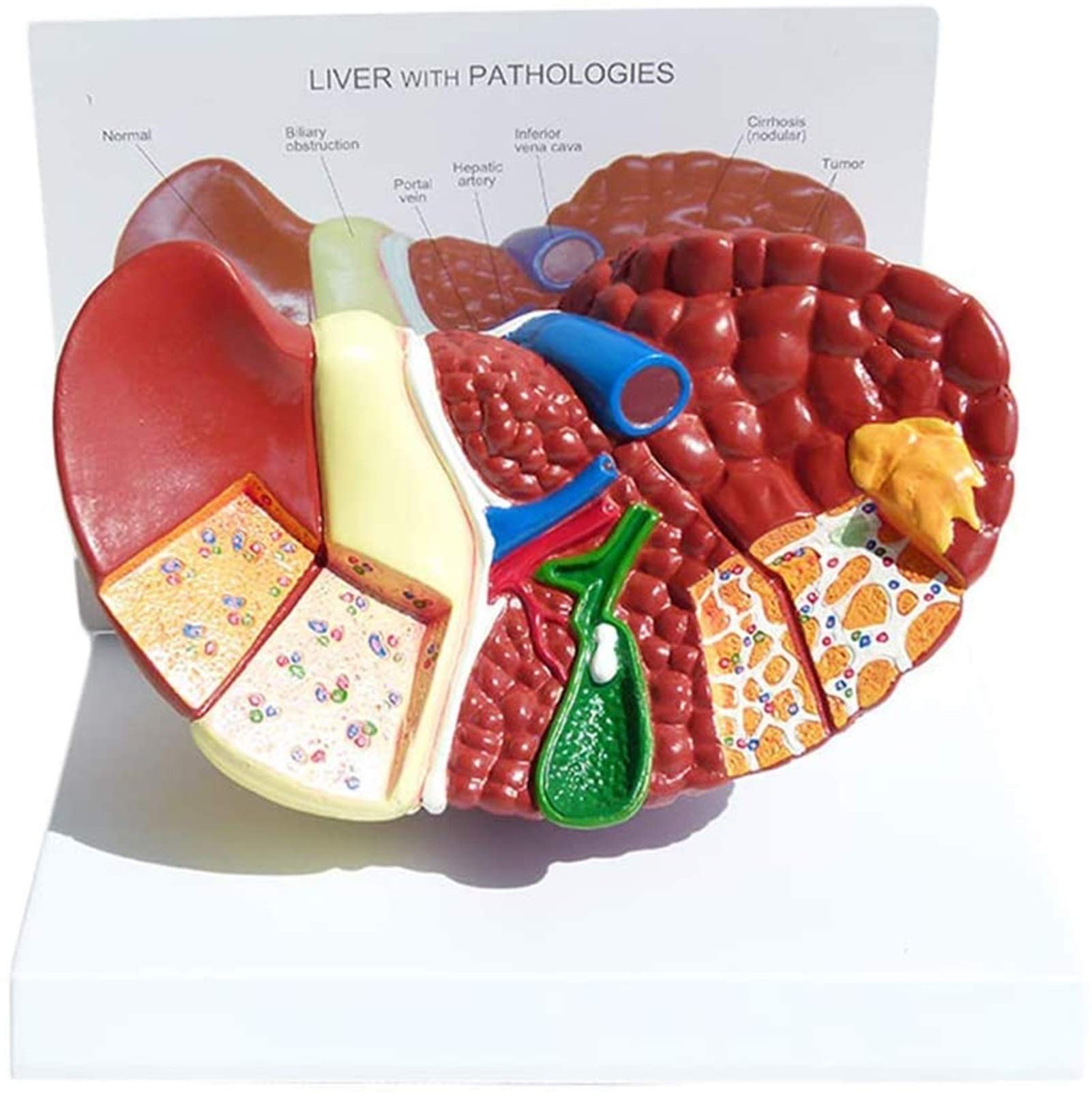Liver Visible Human Project Focal Nodular Hyperplasia (FNH) Liver