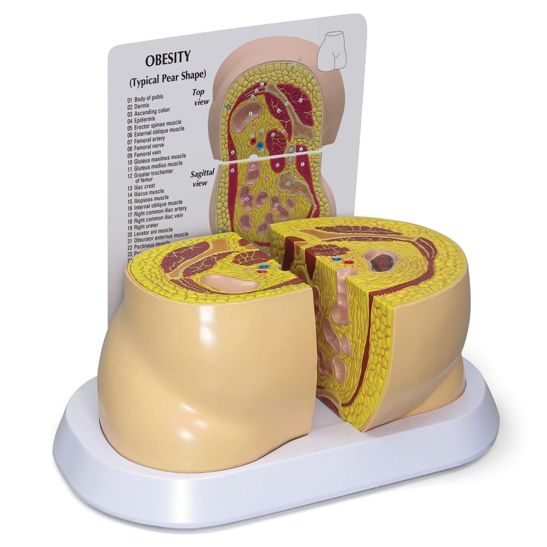 Buy GPI Anatomicals - Obesity Model | Human Body Anatomy Replica of ...