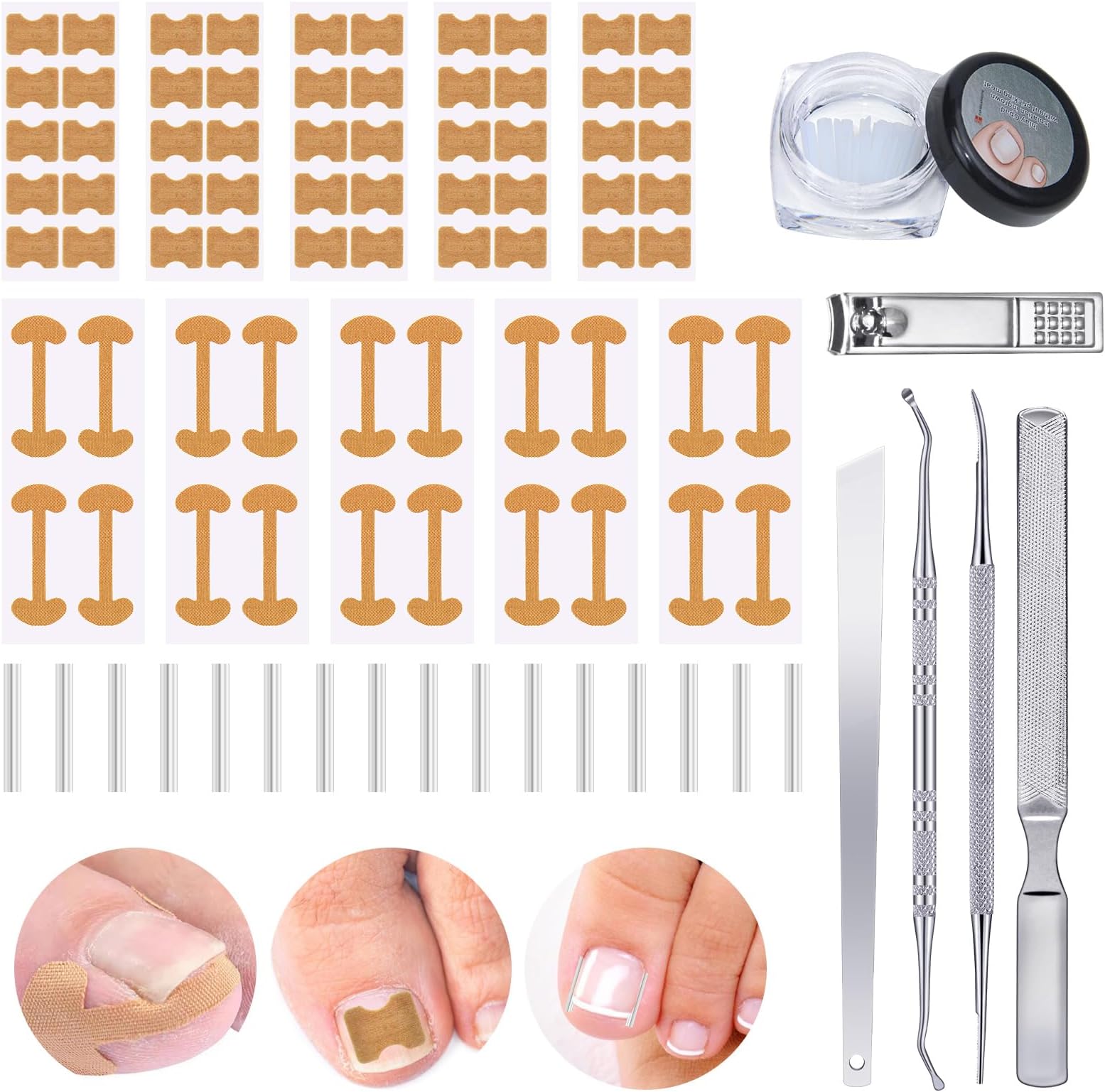 Amazon.com: BEZOX Ingrown Toenail Corrector Set - 40 Pcs Pain-Free ...