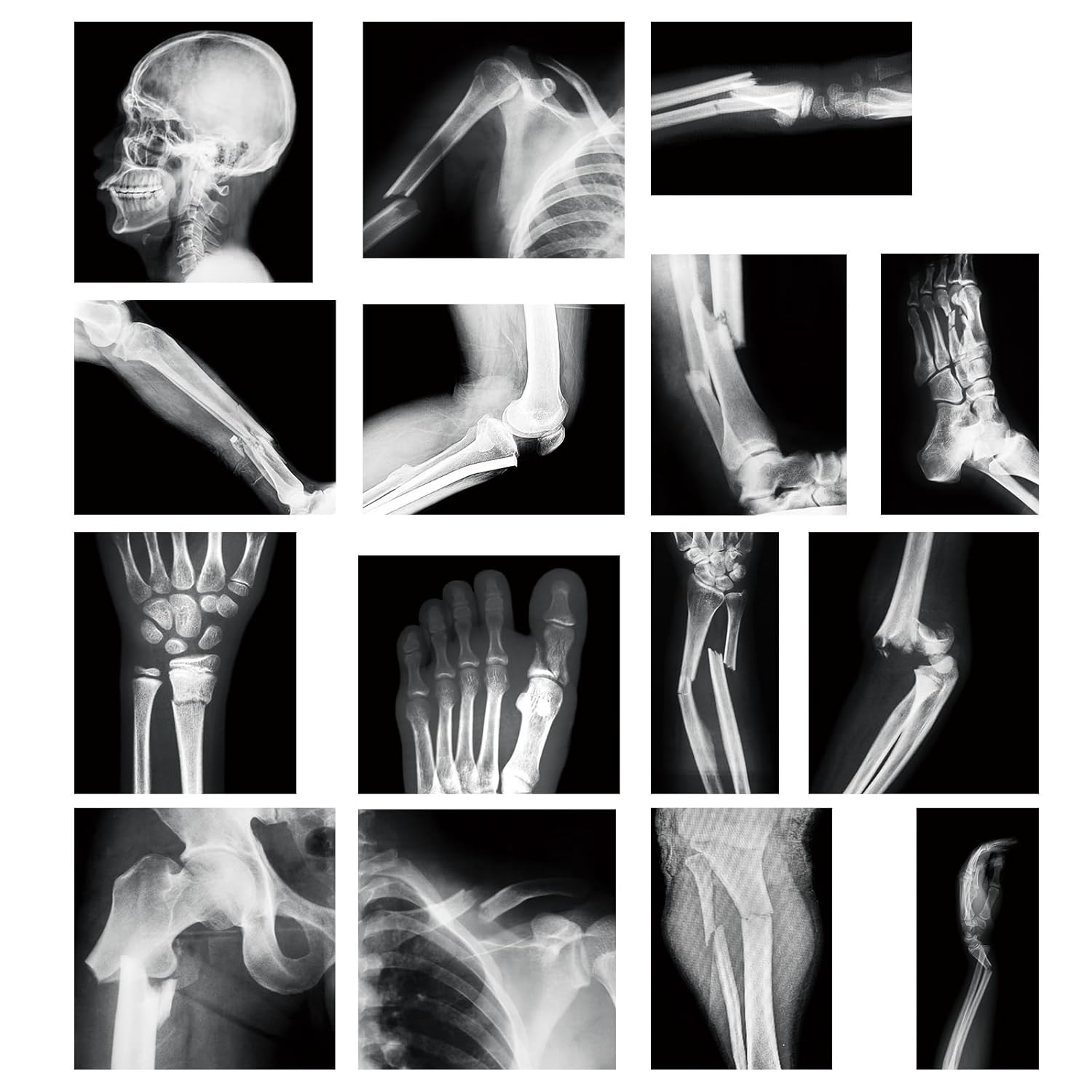 Amazon.com: Sayglossy 15 Pcs Broken Bones x Ray Set Human x Rays Black ...