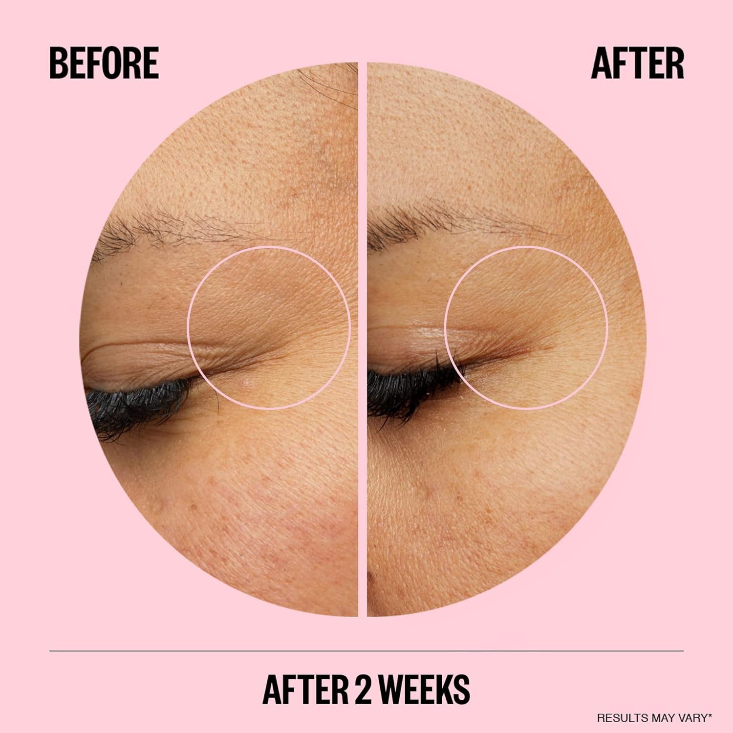 Peace Out Skincare Wrinkles. Dissolving Hyaluronic Acid Microneedling ...