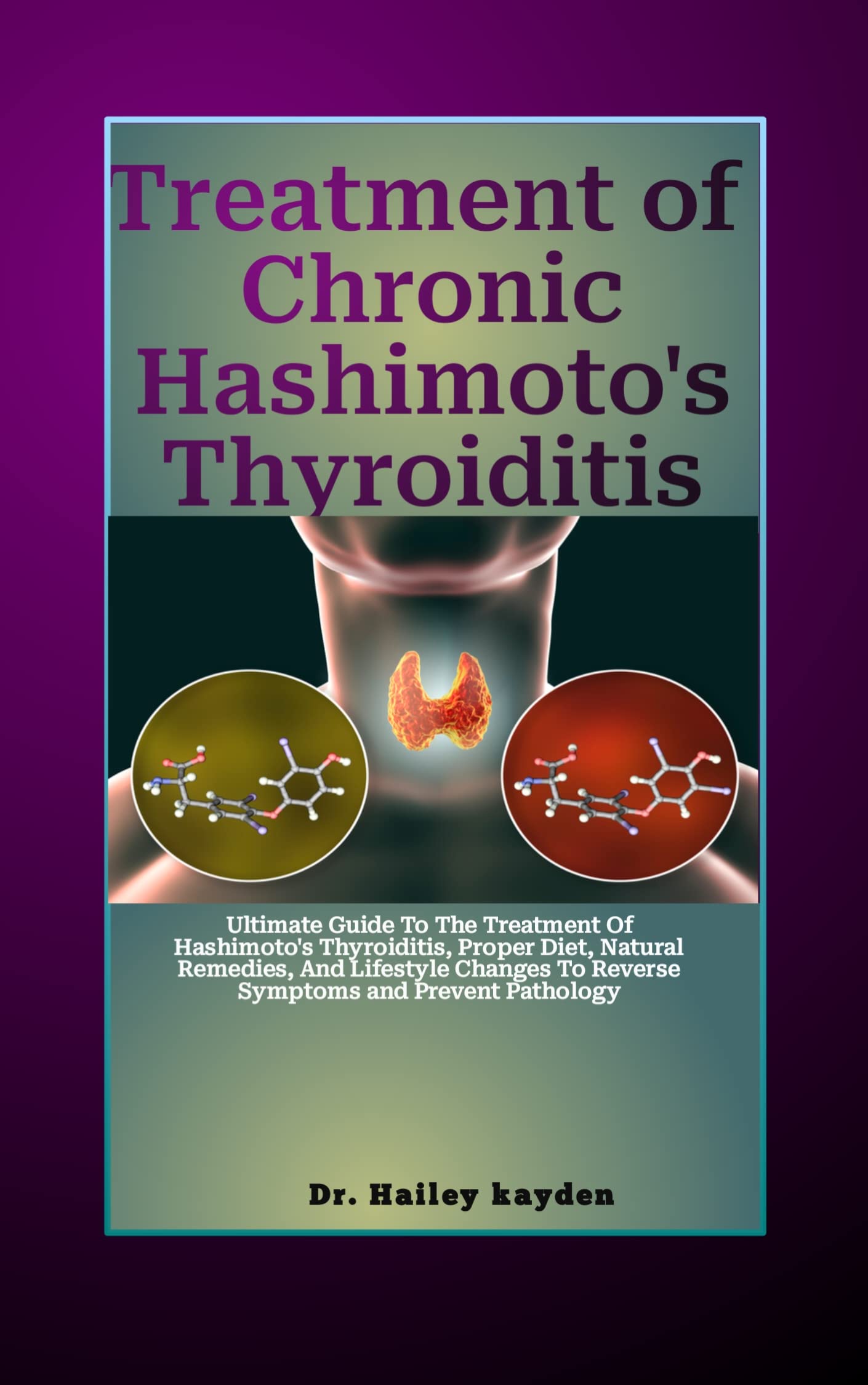 Qiao39s Pathology Chronic Lymphocytic Thyroiditis Hashimo