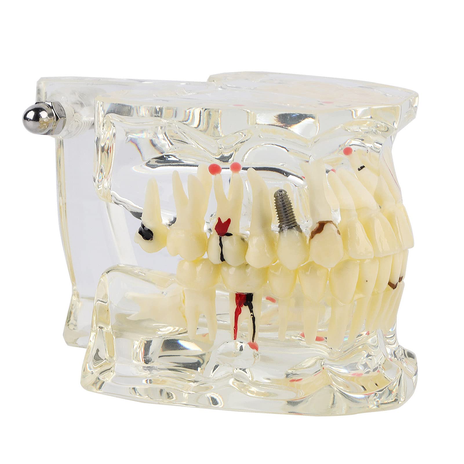 Buy Denture Tooth Model Plastic Tooth Model Pathological Dental Caries ...