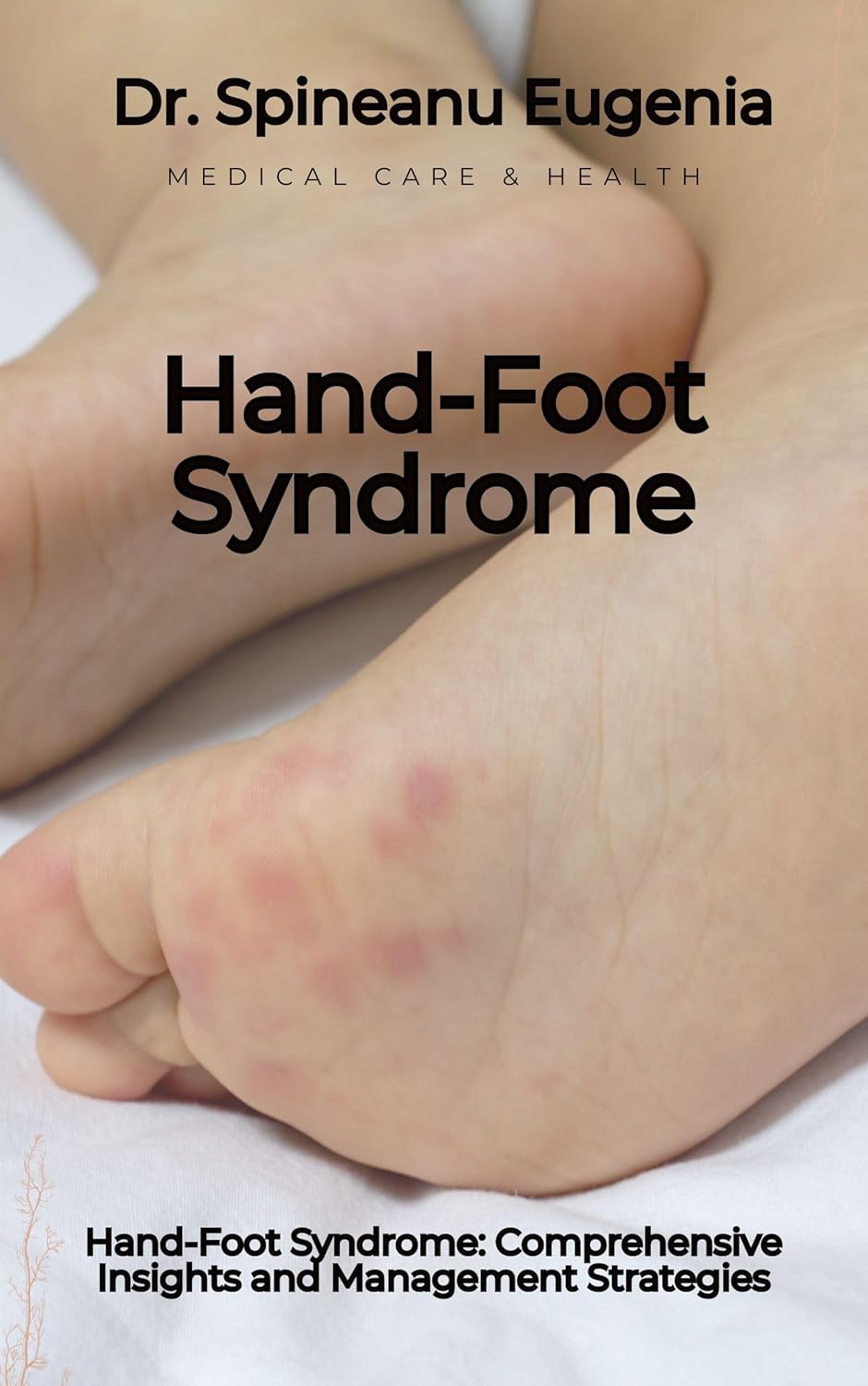 Hand-Foot Syndrome: Comprehensive Insights and Management Strategies ...