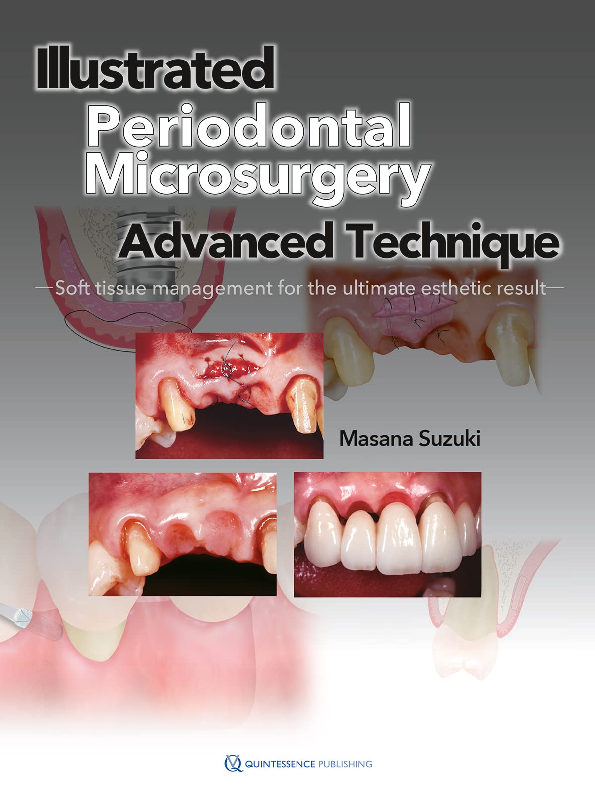 Illustrated Periodontal Microsurgery: Advanced Technique Soft Tissue ...