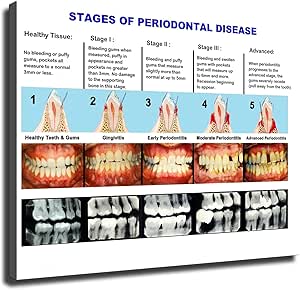 Amazon.com: YsLOPn Dental Clinic Wall Poster Periodontal Disease ...