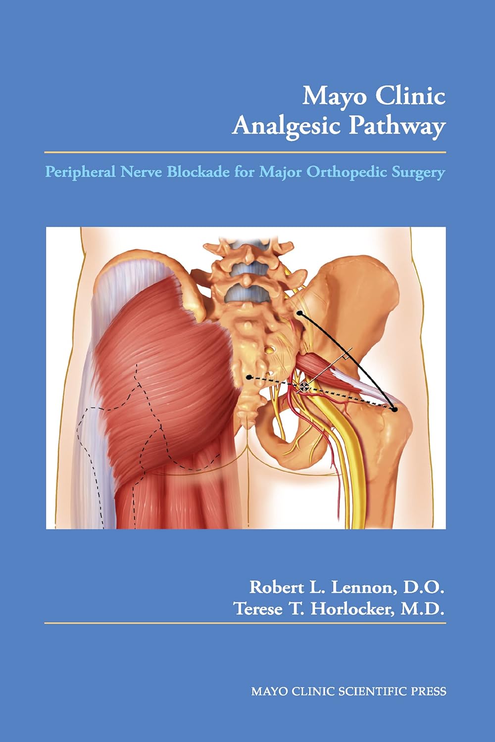 Mayo Clinic Analgesic Pathway: Peripheral Nerve Blockade for Major ...