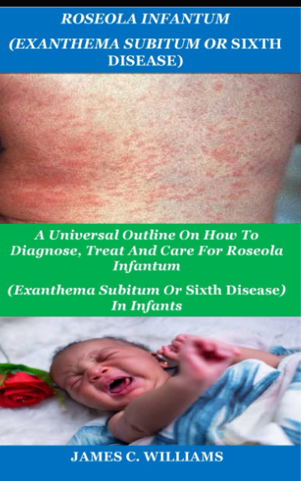 Roseola Infantum Exanthema Subitum Or Sixth Disease A Universal Outline ...
