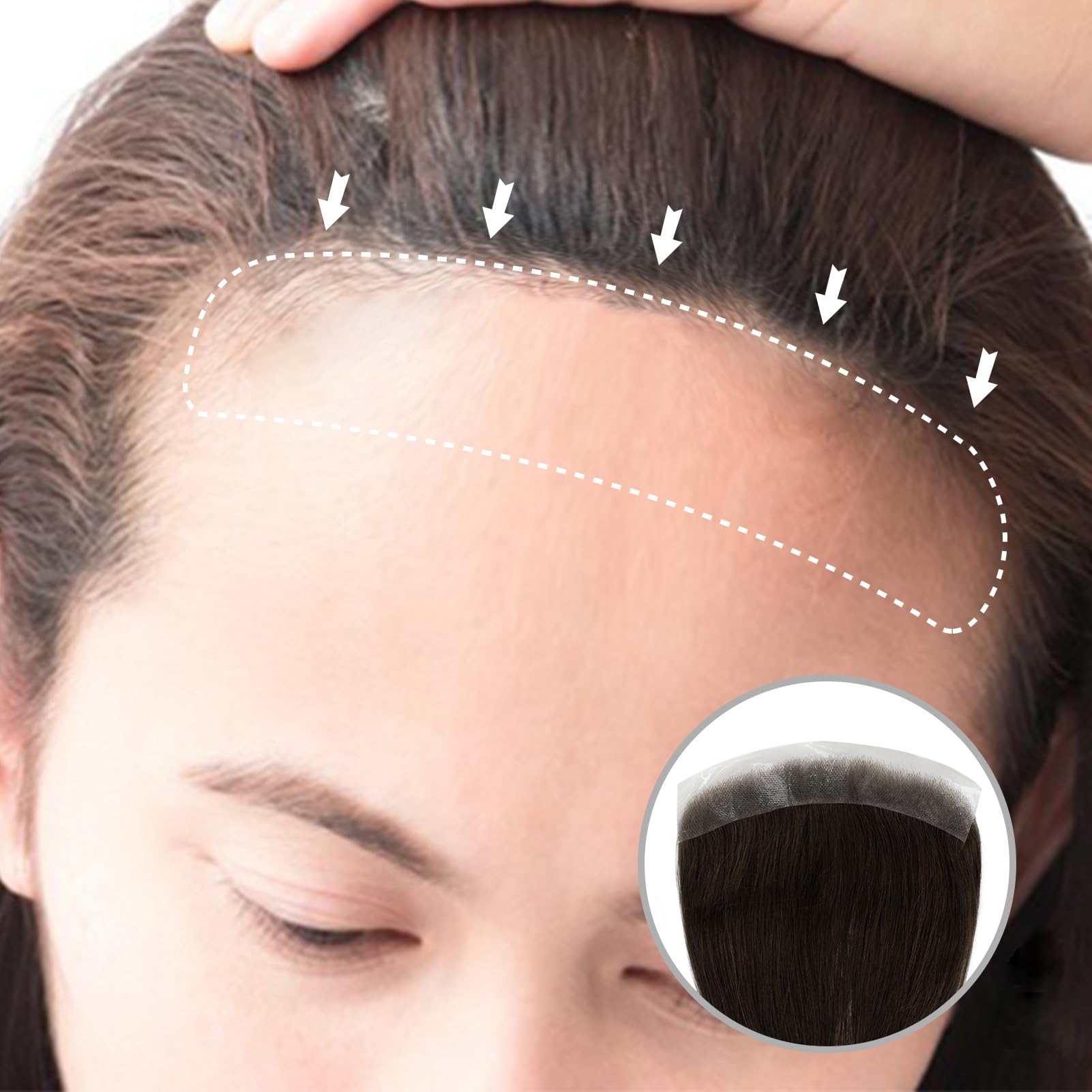 Female Pattern Baldness Receding Hairline