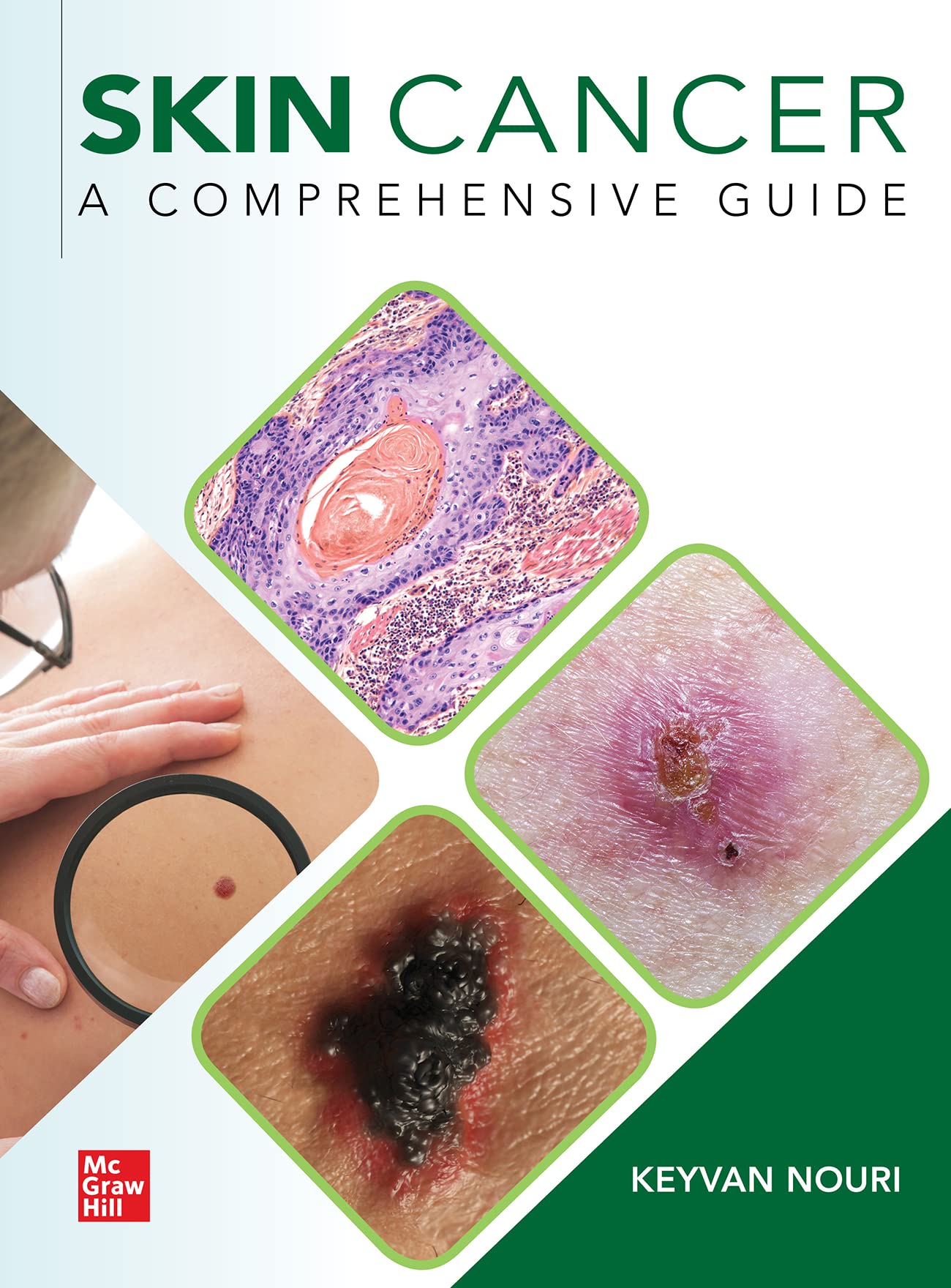 Skin Cancer: A Comprehensive Guide: 9781260453003: Medicine & Health ...