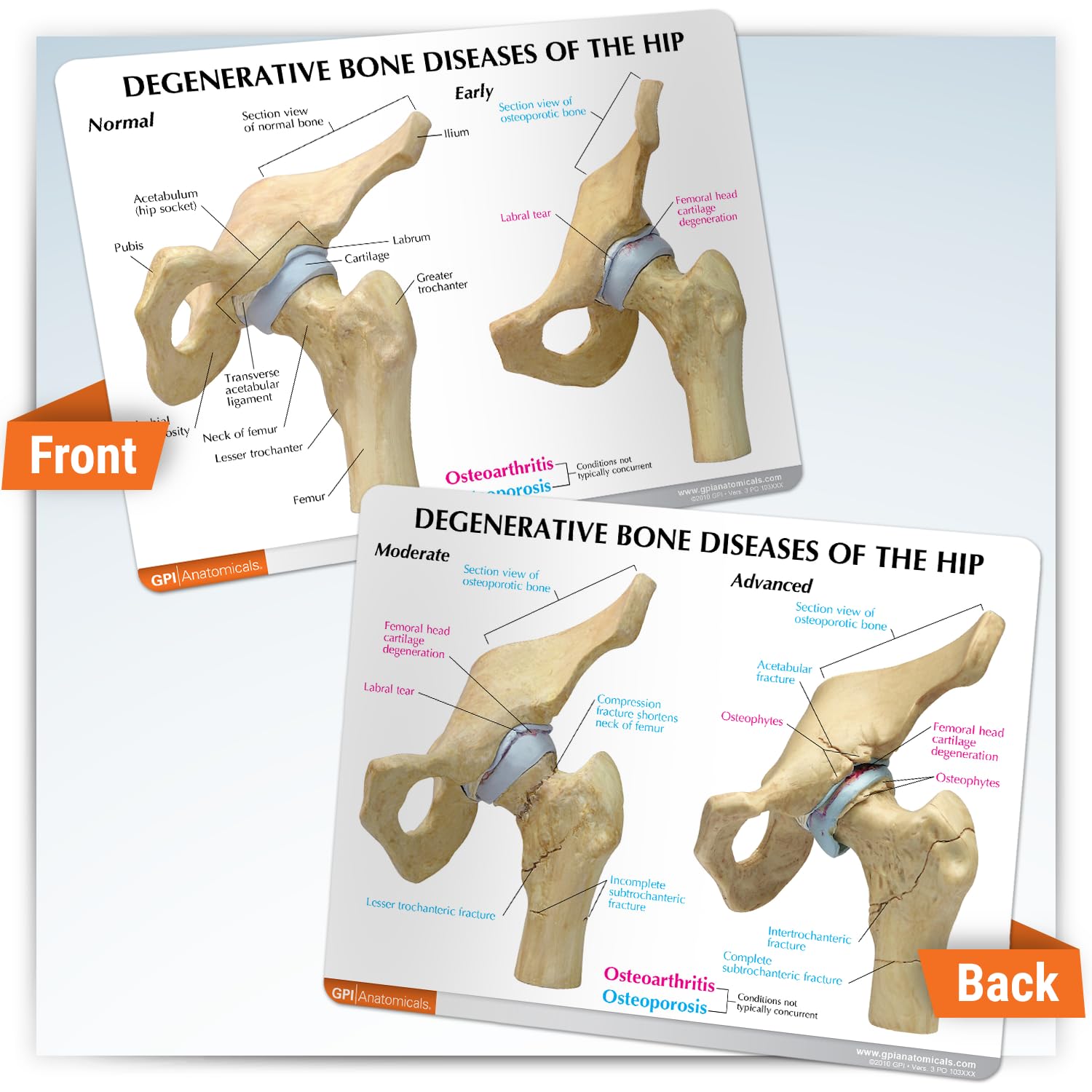 Snapklik.com : 4-Stage Diseased Hip Joint Model Set, Degenerative Bone ...