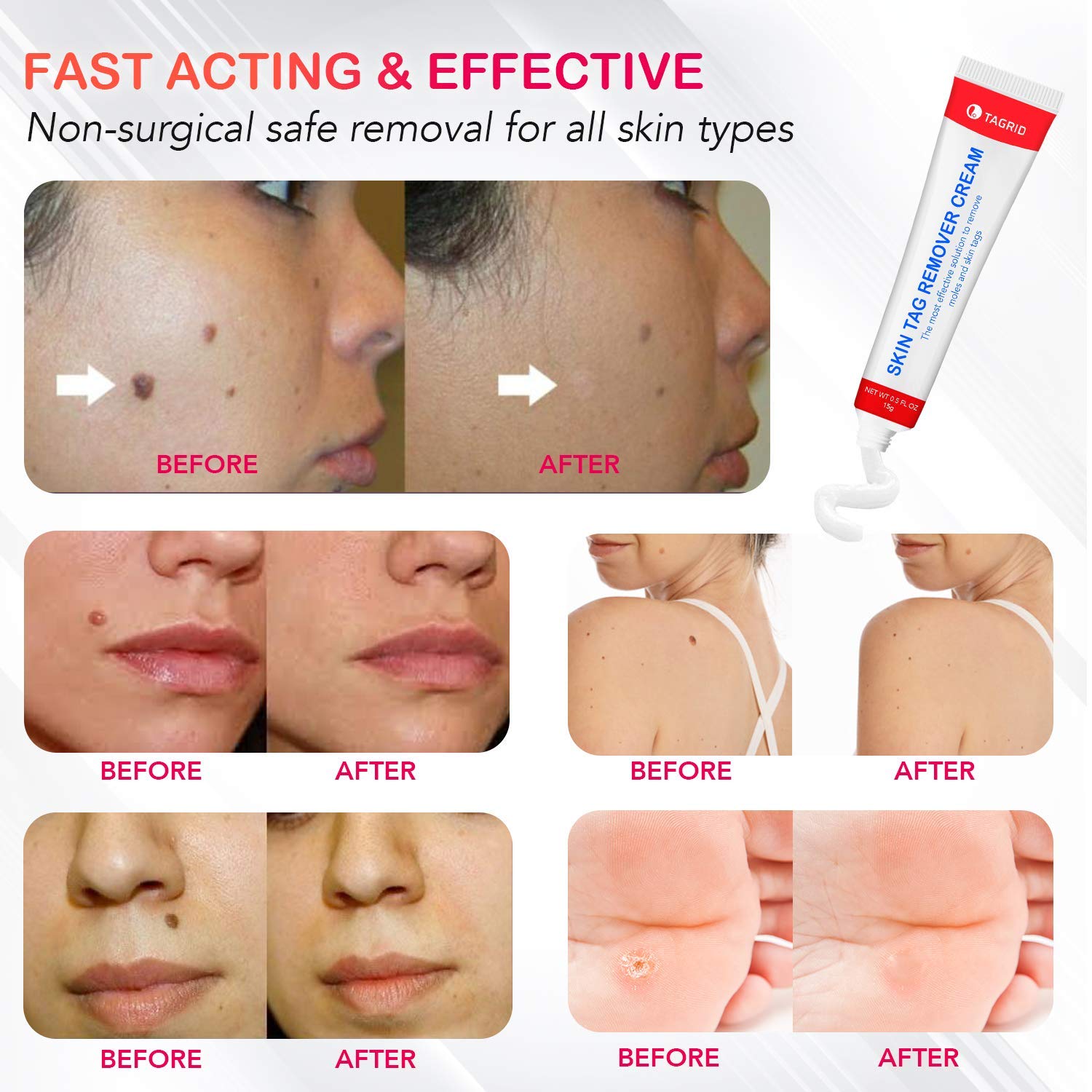 Skin Tag Remover, Warts Remover Cream,Quickly and Easily Remove Common ...