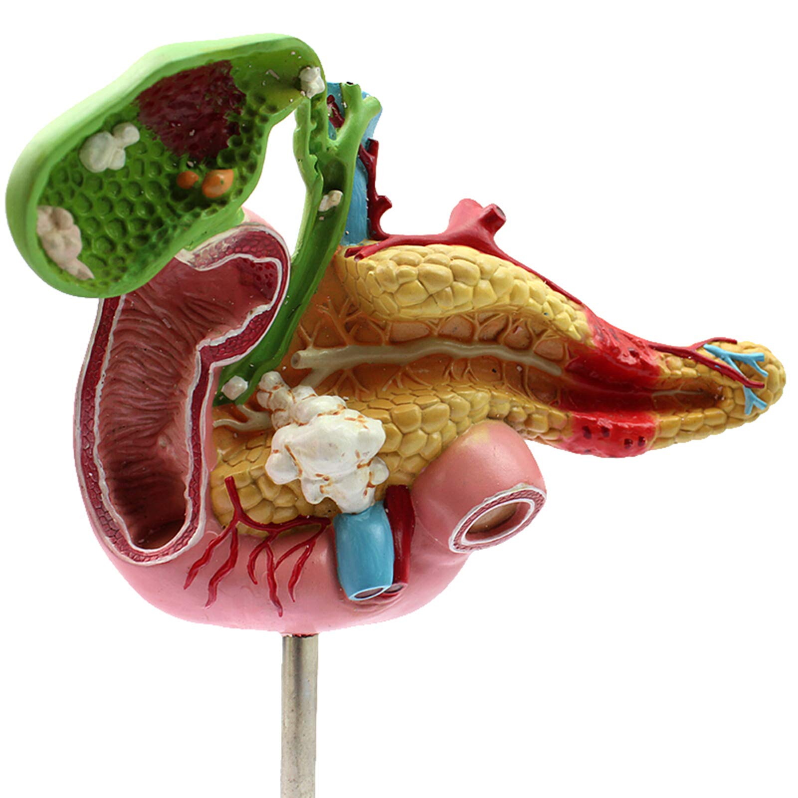 Zxcvbas Pathological Model Of Pancreas Duodenum And Gallbladder Human ...
