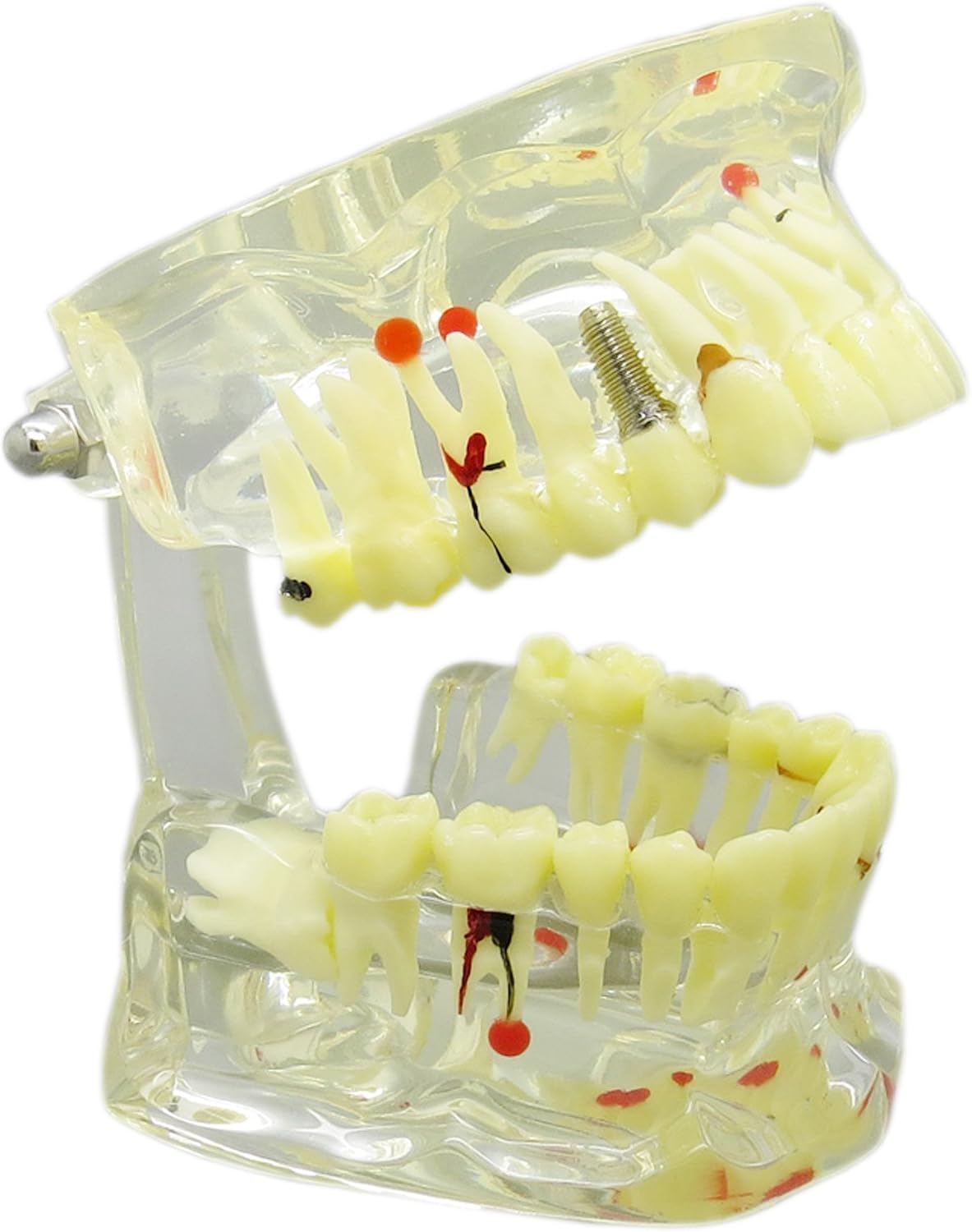 Amazon.com: Dental Typodont Adult Teeth Model Demo Implant Periodontal ...
