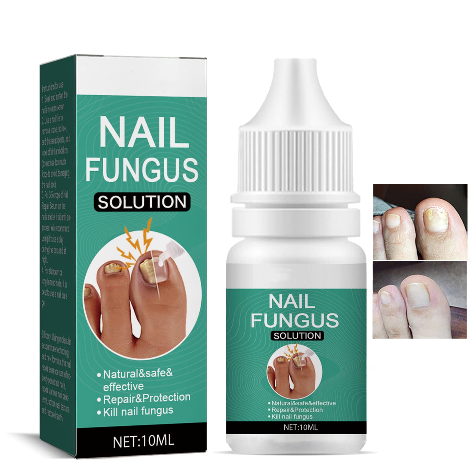 Fungal Nail Treatment for Toenail Extra Strong, 10ML Nail Fungus ...