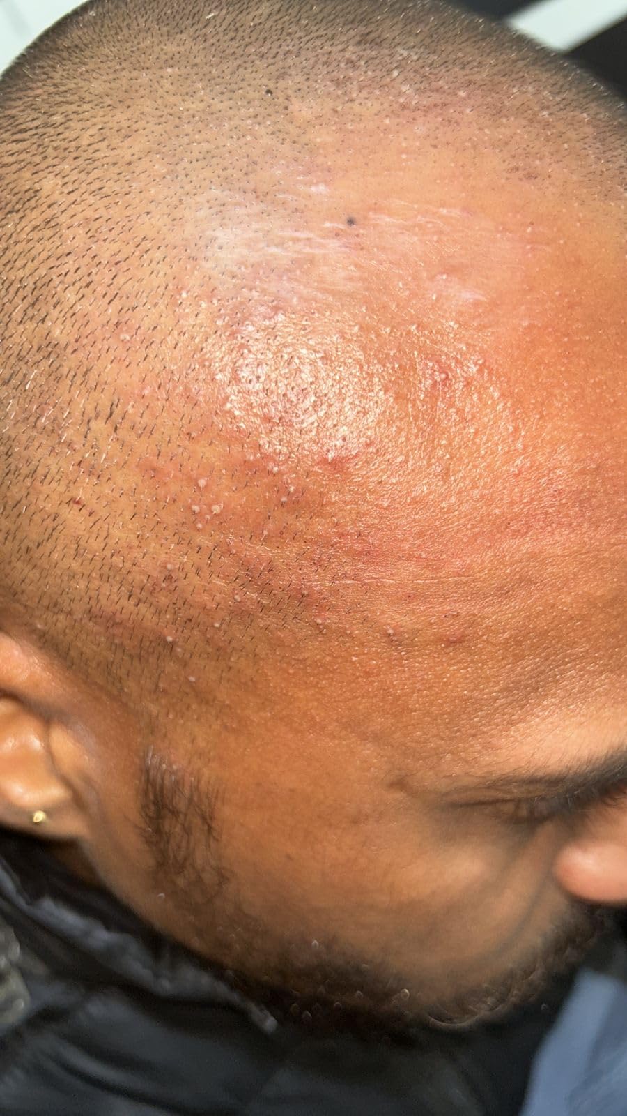 Buy Gunja Oil and Lepa for Hair Growth and alopecia (Combo) |Natural ...