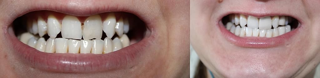 Amazon.com: ARC Teeth Whitening Strip Kit, Smile Amplifier Kit, 14 ...