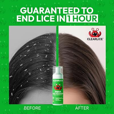 Lice Treatment Foam for Kids & Adults – Extra Nepal | Ubuy