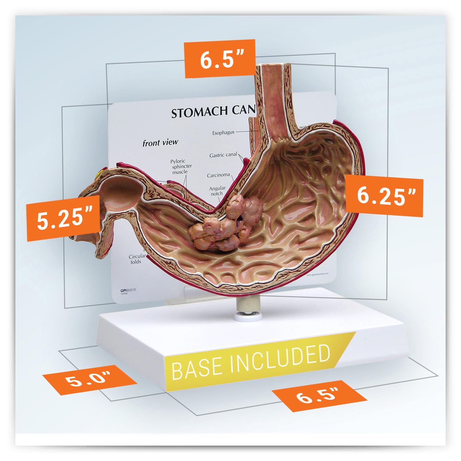 Snapklik.com : Stomach Cancer Model, Replica For Human Anatomy And ...
