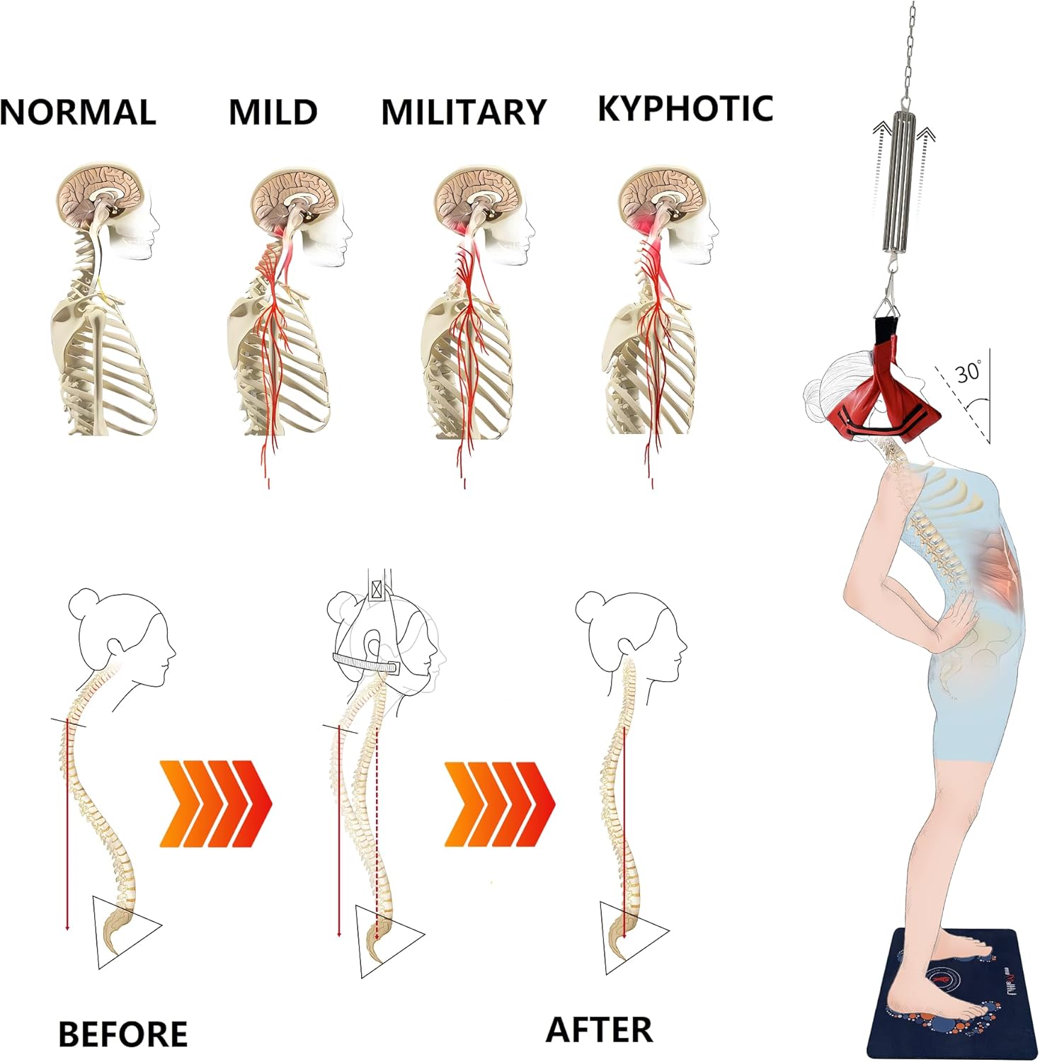Cervical Traction Apparatus, Spinal Decompression Chile | Ubuy