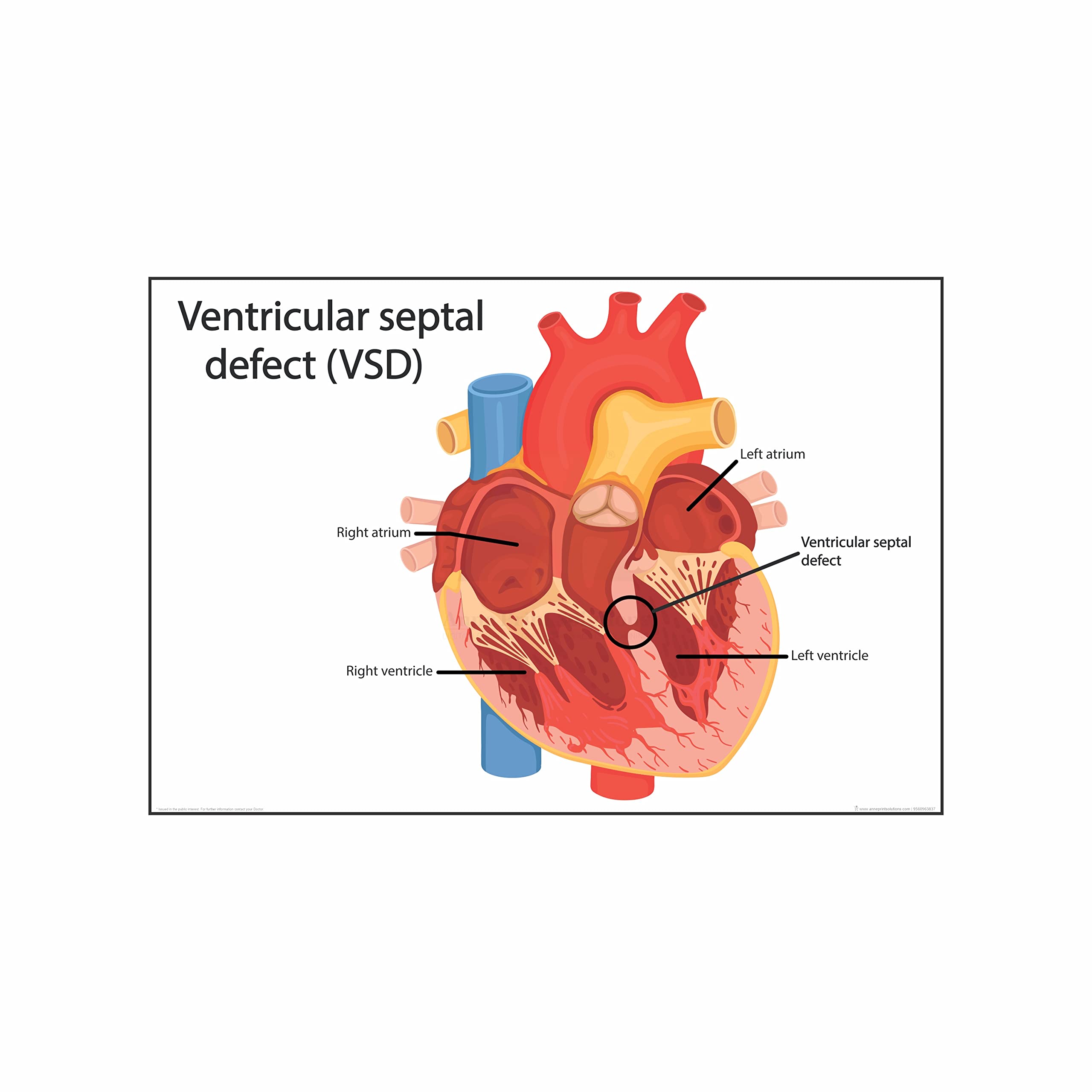 Anne Print Solutions® Ventricular septal defect chart Posters For ...