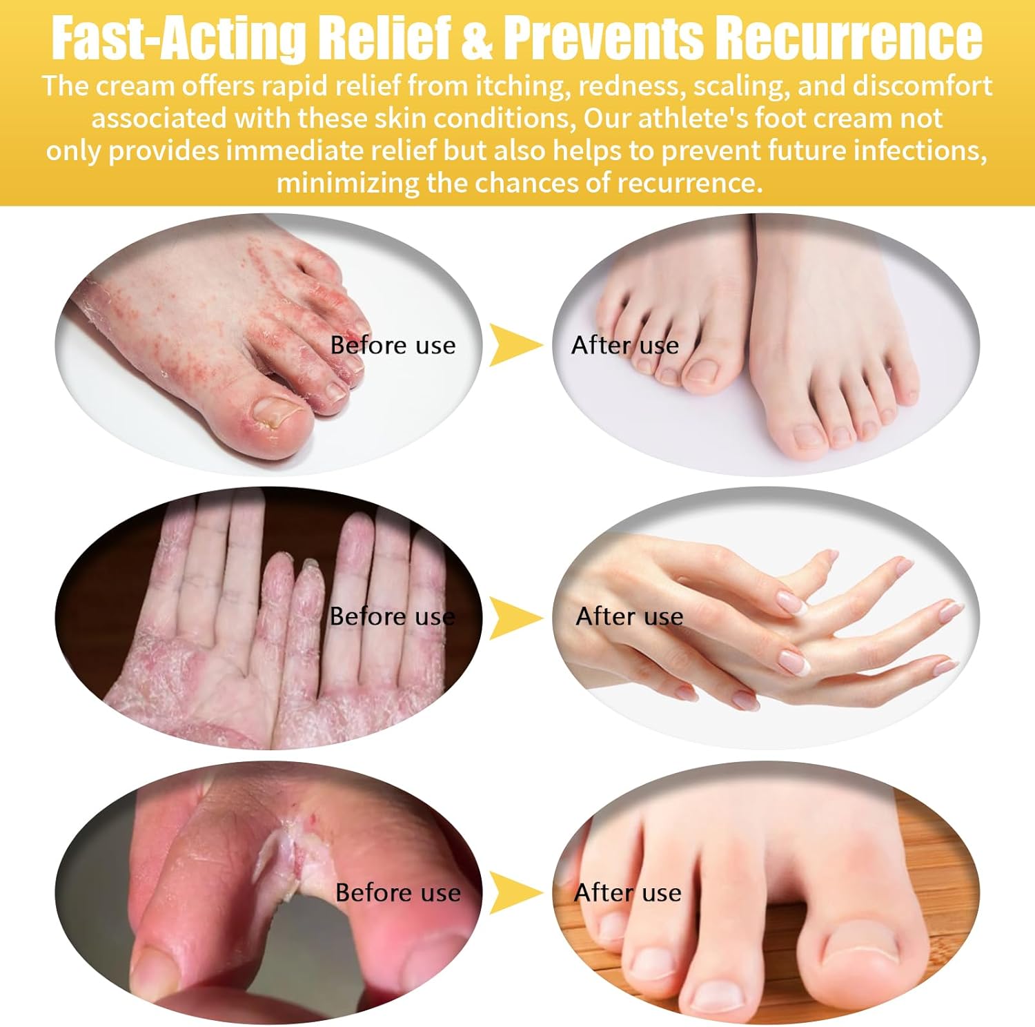 Tea Tree Oil Relief Cream, Soothes Jock Itch, Foot Philippines | Ubuy