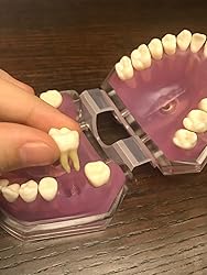 Amazon.com: Dental Implant Teeth Model Study Teach Standard Model with ...