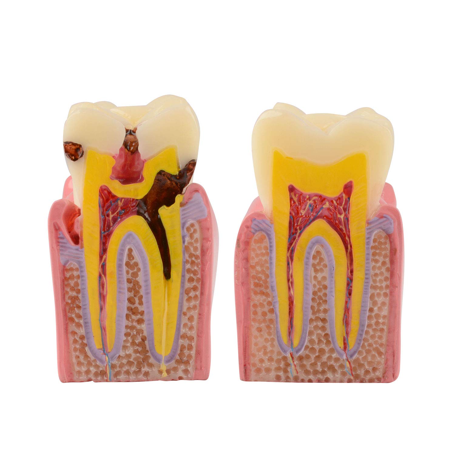 Snapklik.com : Ultrassist Dental Tooth Decay Model 6 Times Dental ...