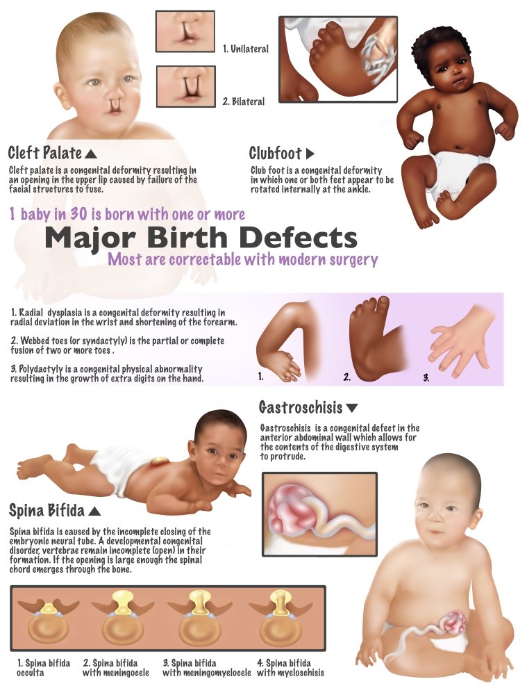 Birth Defects In Babies