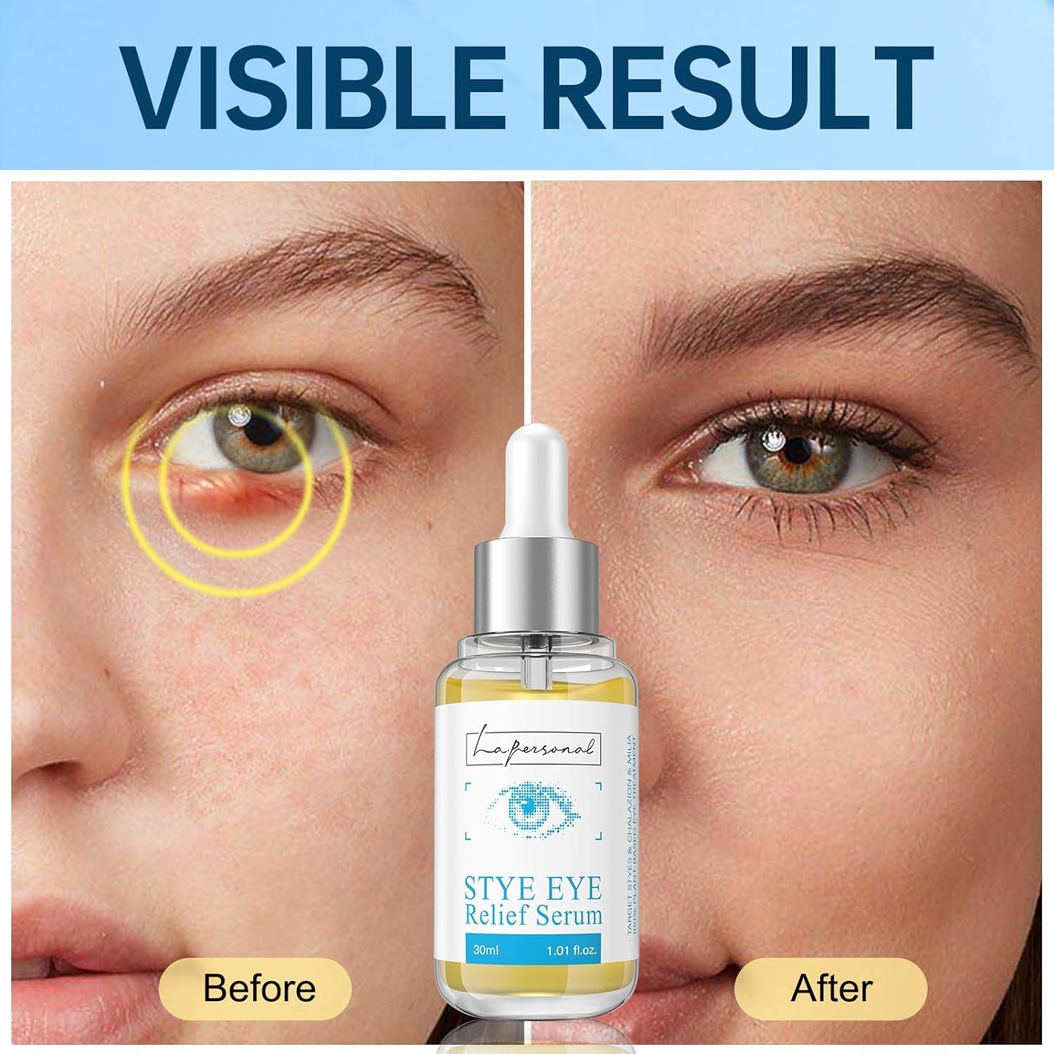 Stye Eye Treatment, LA.PERSONAL Chalazion Remover, Eye Serum for Styes ...