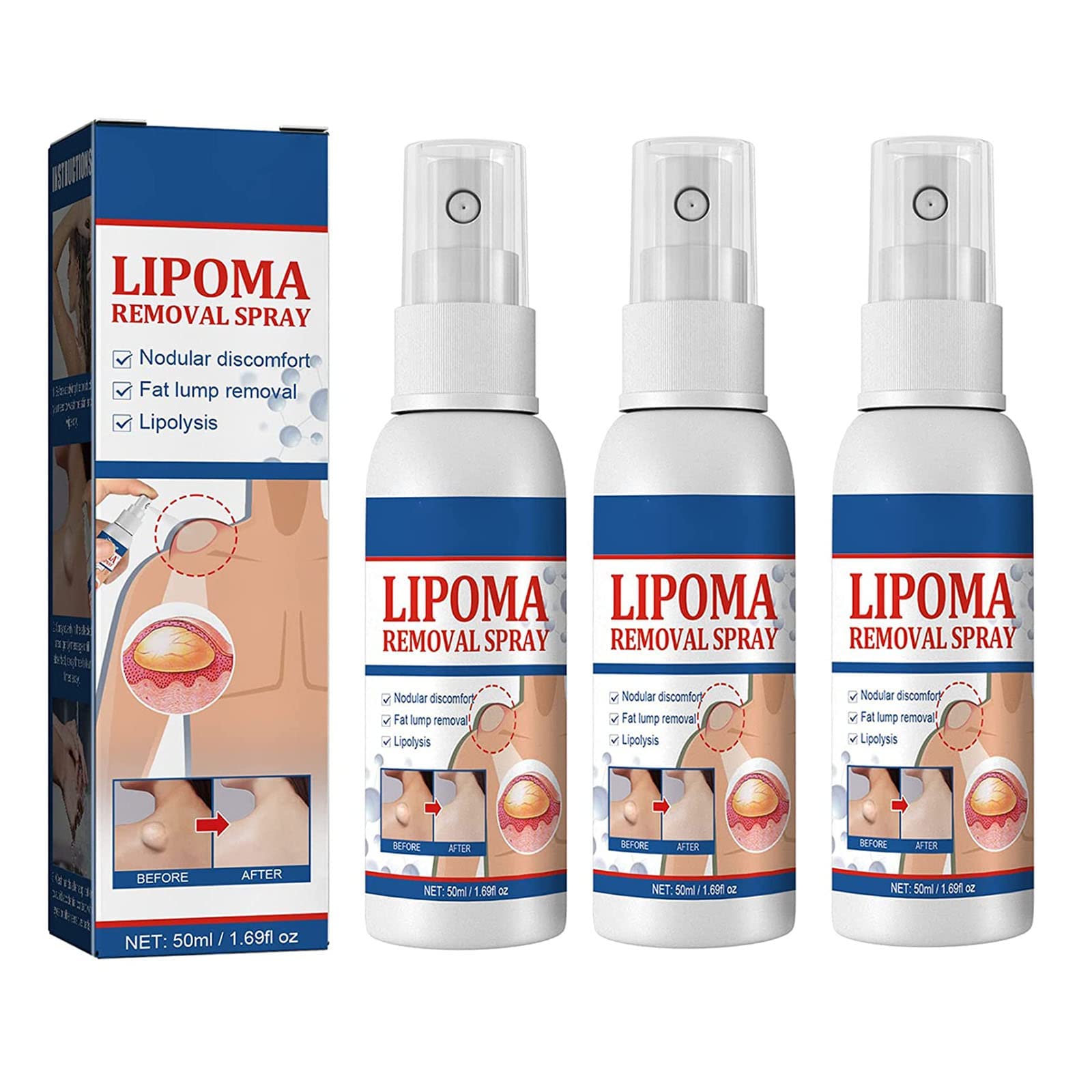 Buy Lipoma Removal Spray, LipoOut Lipom Healing Reduction Spray, 50ml ...