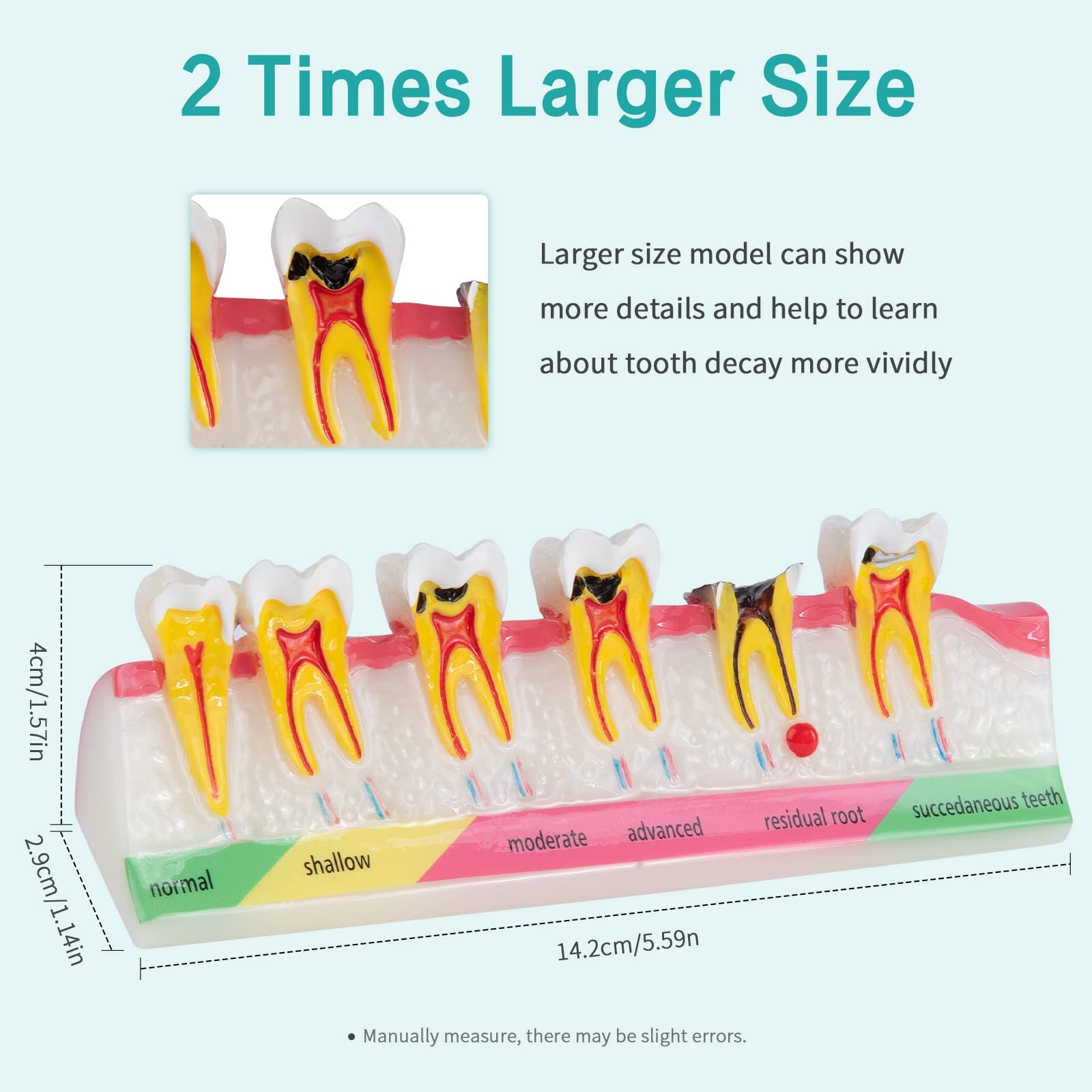 Dental Tooth Model Buy NaoSIn-Ni Periodontal Disease Teeth Model Dental ...