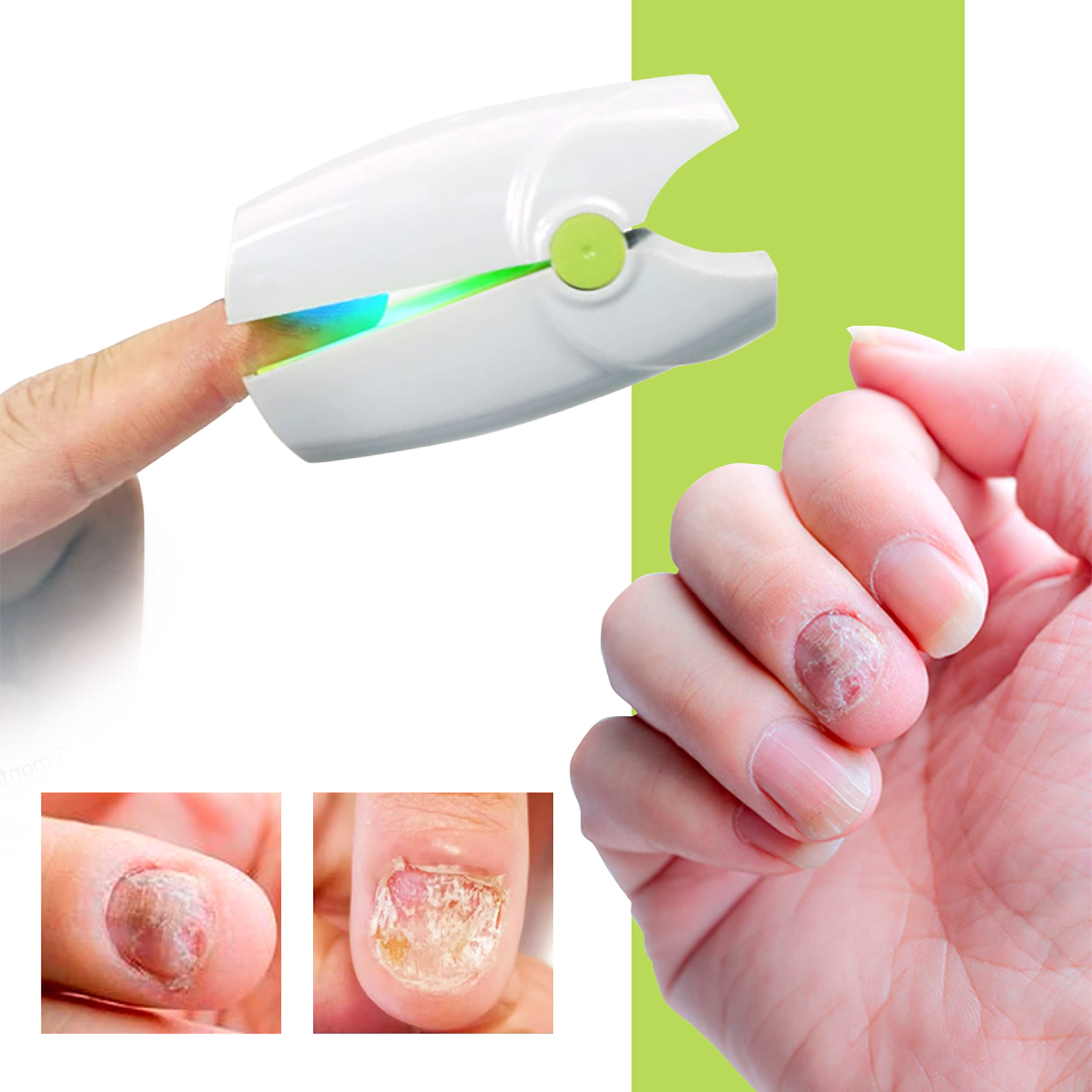 Buy Fungus Therapy Pro - Laser Nail Fungus Treatment, Fungal Treatment ...