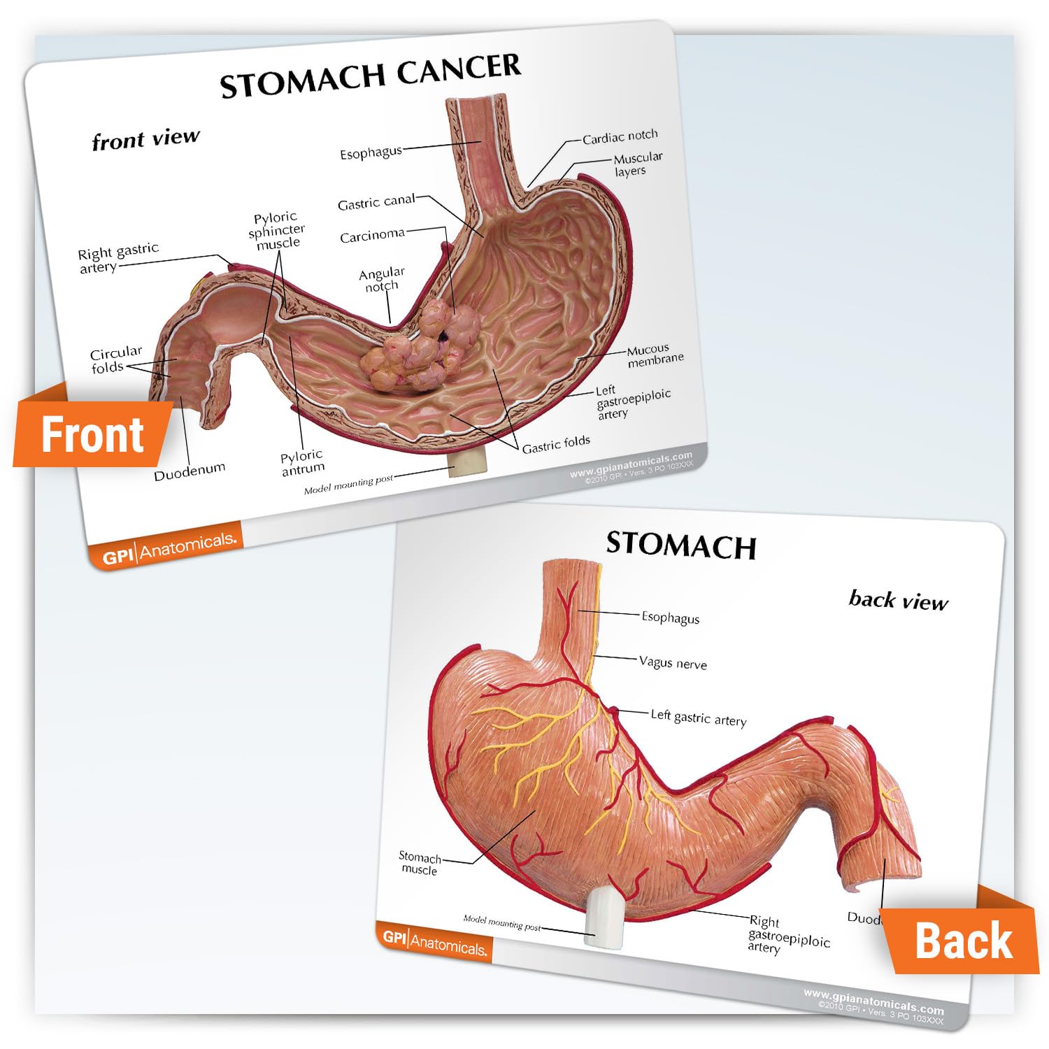 Snapklik.com : Stomach Cancer Model, Replica For Human Anatomy And ...