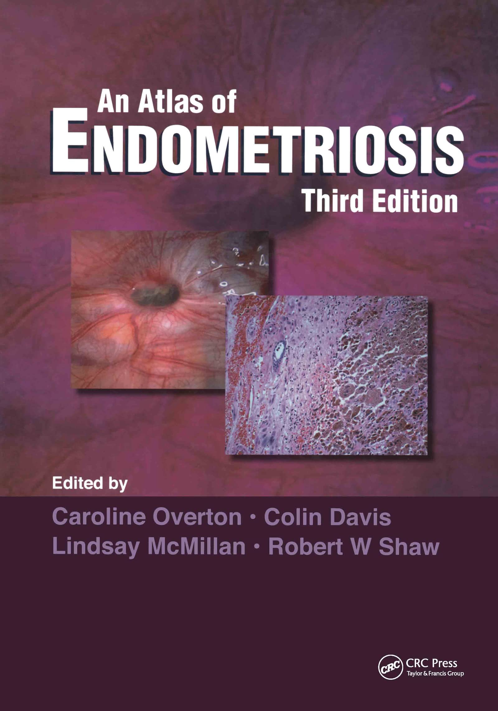 An Atlas of Endometriosis (Encyclopedia of Visual Medicine Series ...