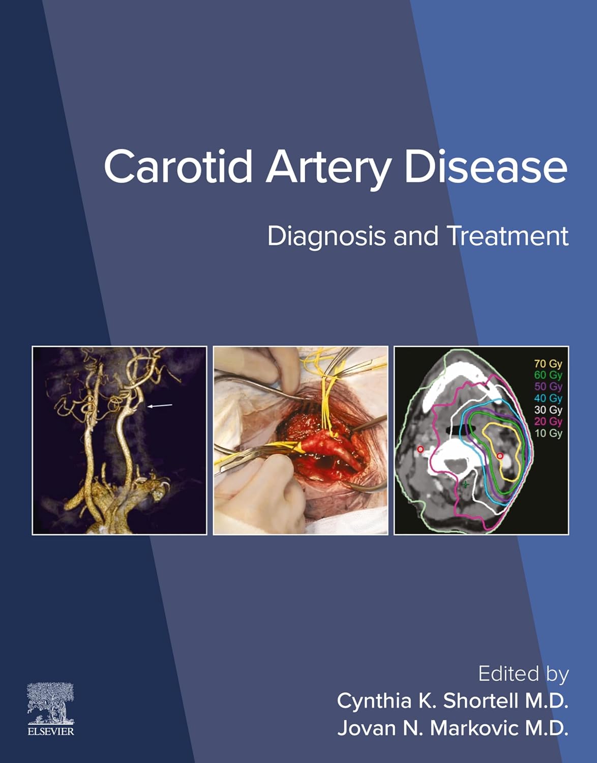 Amazon.com: Carotid Artery Disease: Diagnosis and Treatment eBook ...